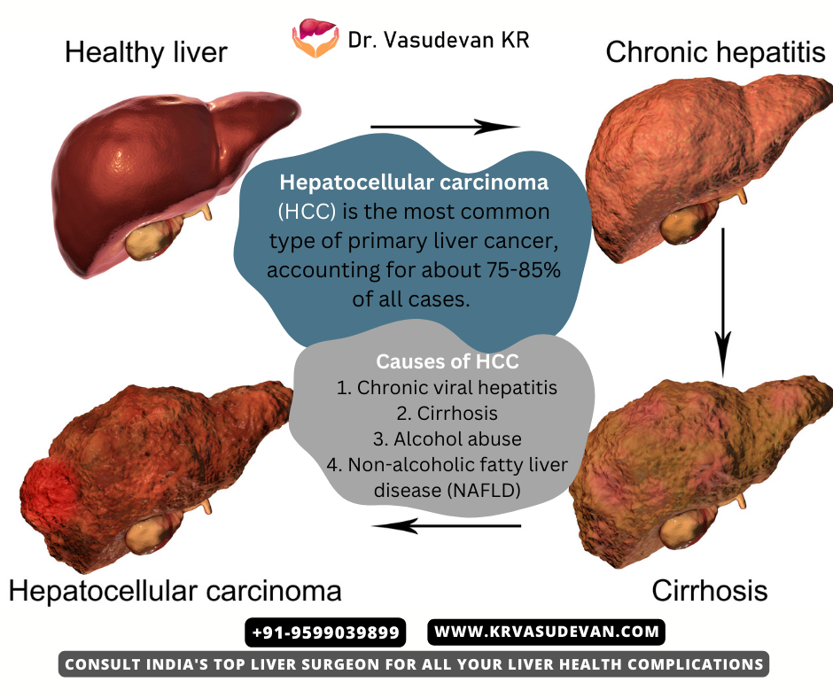 Hepatocellular Carcinoma Dr Vasudevan K R Hepatocellular Carcinoma Dr Vasudevan K R